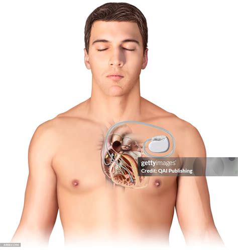 Artificial Pacemaker Electronic Implant That Emits An Electrical News Photo Getty Images