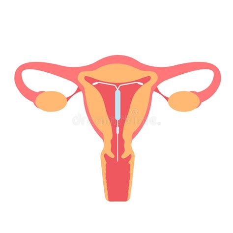 Iud Uterus Stock Illustrations 108 Iud Uterus Stock Illustrations