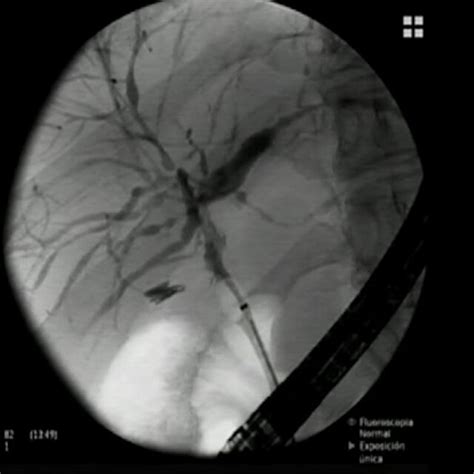 A 58 Year Old Man With Long Lasting Primary Sclerosing Cholangitis And Download Scientific
