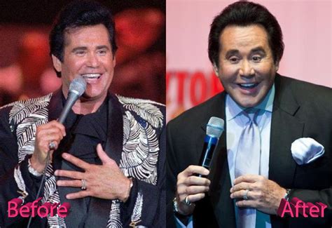 Wayne Newton Plastic Surgery A Las Vegas Facelift