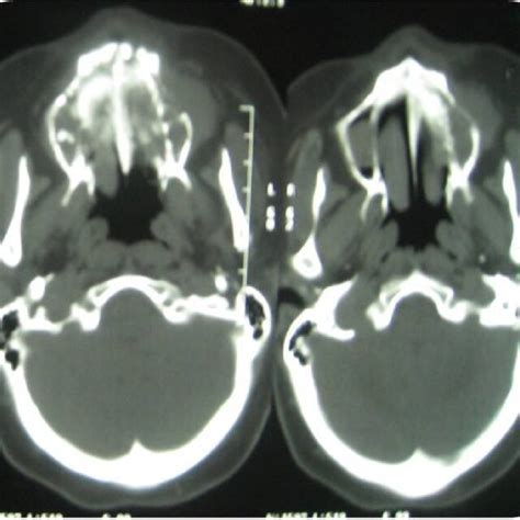 An Axial Ct Image With Soft Tissue Algorithm Revealing Irregular