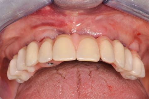 Interim Prosthesis After Implant Placement Download Scientific Diagram