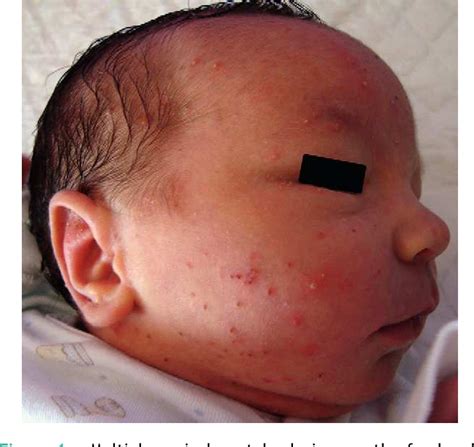 Figure 1 From Transient Neonatal Pustular Melanosis Semantic Scholar