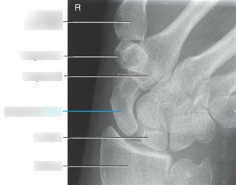 15 Degree Cr Angle Pa Axial Scaphoid Ulnar Deviation Diagram Quizlet