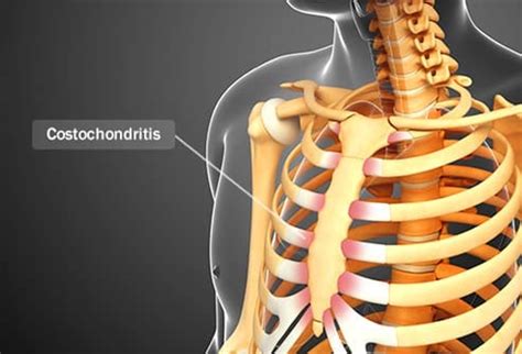 Costochondritis Brustschmerzen In Fibromyalgie Dzlqy