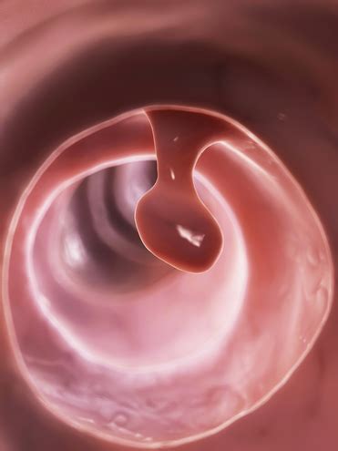 Polyps Of The Gastrointestinal Tract