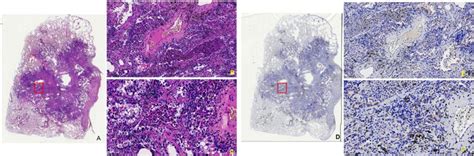 Microscopic Images Show The A C Acinar Adenocarcinoma Characterized