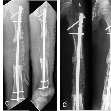 Twenty One Year Old Male Suffered From Bone Infection Of The Left Femur