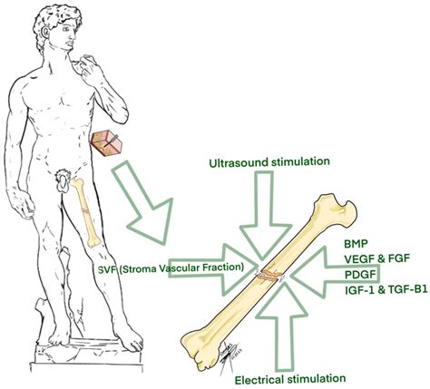 Different Methods Of Bone Fracture Stimulation Download Scientific Diagram