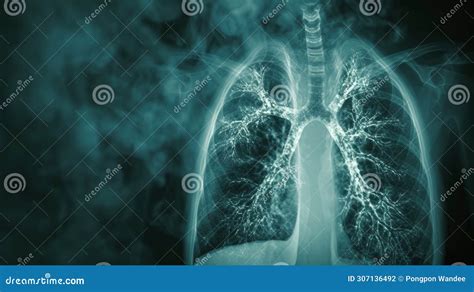 X Ray Image Of Healthy Lungs With Clear Lung Fields Stock Illustration