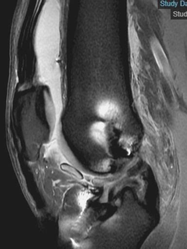 Marcelo Bordalo On Linkedin Chondral Lesion With Sharp Margins Always