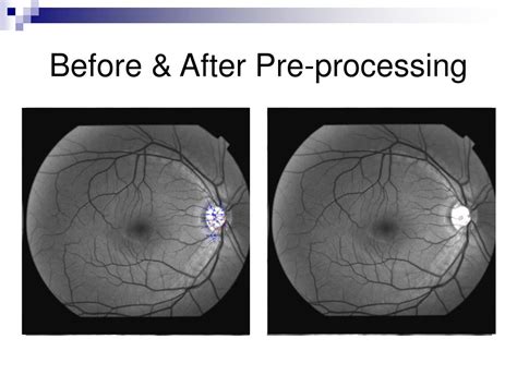 Ppt Active Contours Technique In Retinal Image Identification Of The Optic Disk Boundary