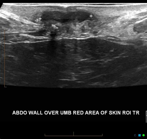 Umbilical Granuloma Ultrasound