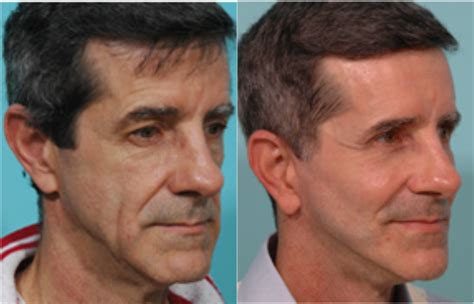 Malarimplants Beeson Cosmetic Surgery