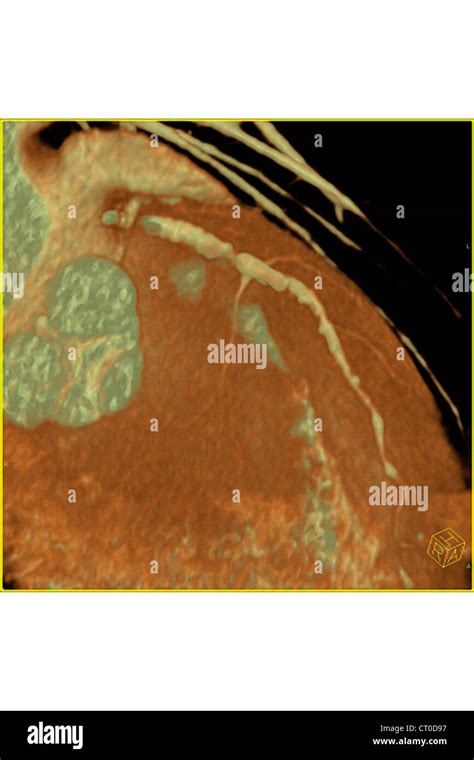 CORONARY STENOSIS Stock Photo Alamy