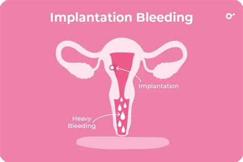 Is Heavy Implantation Bleeding Normal