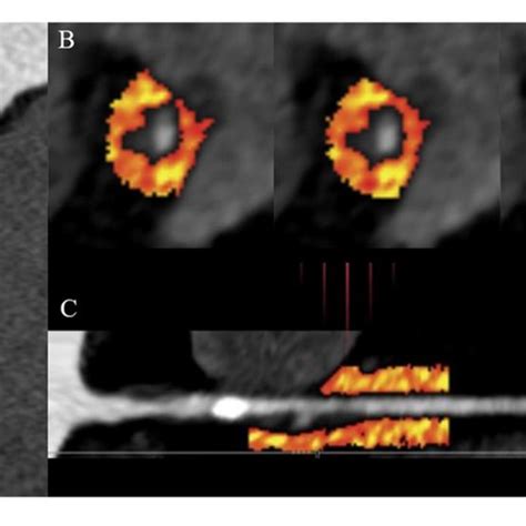 Quantification Of Pcat Ct Attenuation Of Low Attenuation Plaques In