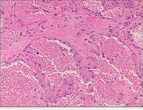Epithelioid Angiosarcoma Full Article Primary Thyroid Angiosarcoma