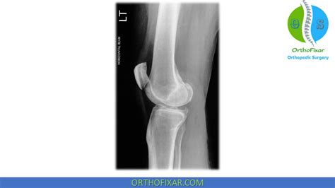 Patellar Dislocation Orthopedic Learning
