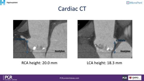 Vitaflow The Electrically Enable Self Expanding Tavi Valve