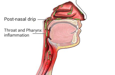 Post Nasal Drip Wikiwand
