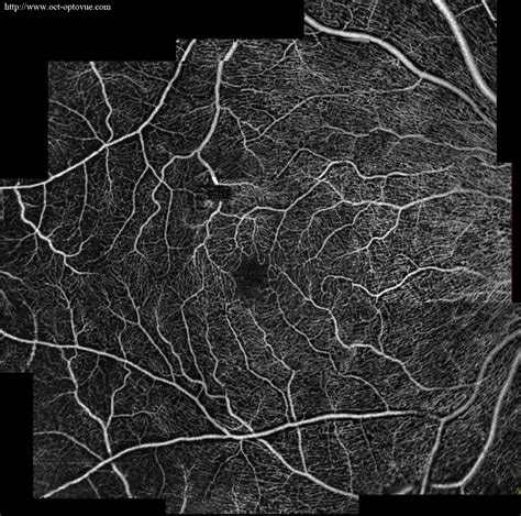 oct angiography and armd