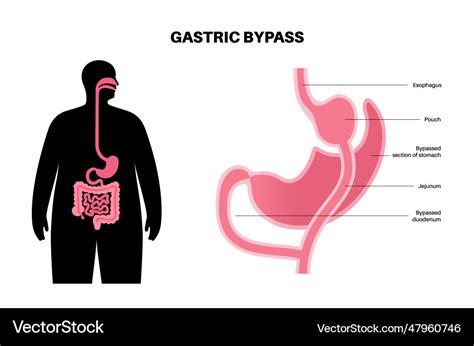 Gastric Bypass Surgery Royalty Free Vector Image