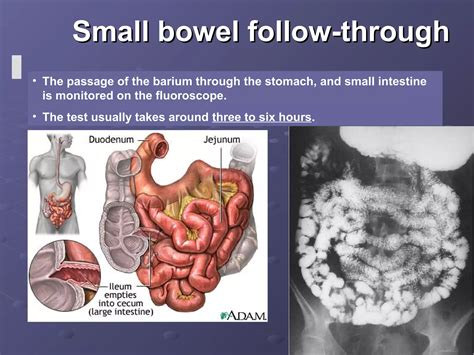 Ba Examination Of Gi Tract Ppt