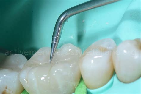 Clinical Application Of Bulk Fill Resins In Posterior Direct Restorations Benefits And Outcomes