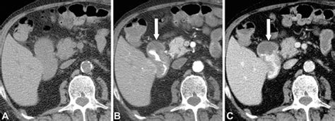 Gastrointestinal Bleeding At Ct Angiography And Ct Enterography