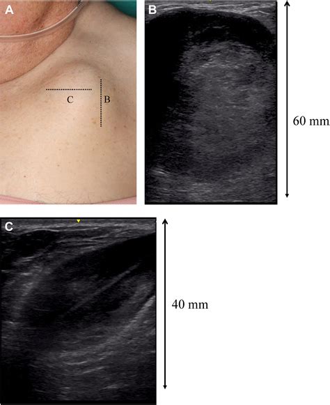 Chronic Expanding Hematoma Developing Over 10 Years In A Pacemaker