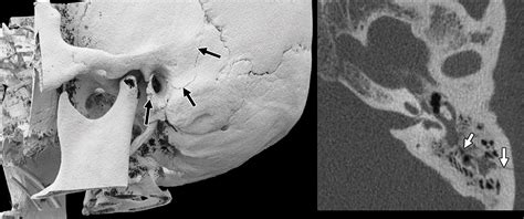 Ct Of Skull Base Fractures Classification Systems Complications And