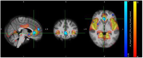 Beyond The Gender Binarism Neural Correlates Of Trans Men In A Functional Connectivityresting