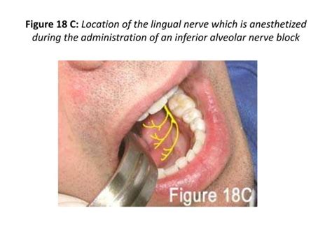Mandibular Nerve Block Pptx