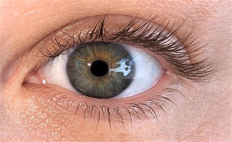 Central Heterochromia Brown