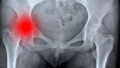 Hip Pinning Johns Hopkins Medicine