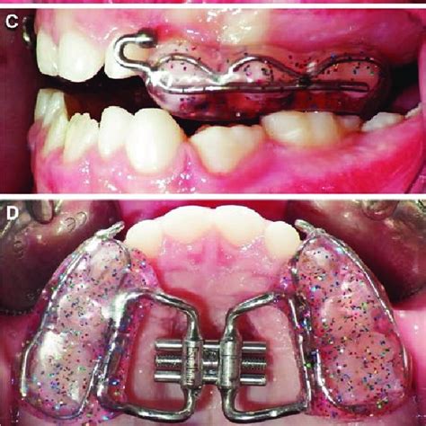 Bonded Maxillary Expander In Intraoral Upper Occlusal View A Frontal