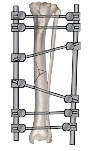 External Skeletal Fixation Flashcards Quizlet