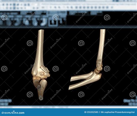 Ct Scan Of Elbow Joint Stock Image 255352603