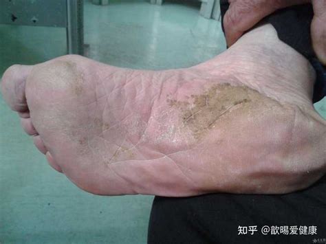 掌跖角化过度对身体会产生哪些影响？ 知乎