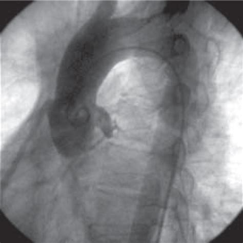Multislice Computed Tomography Confirms Left Main Download Scientific