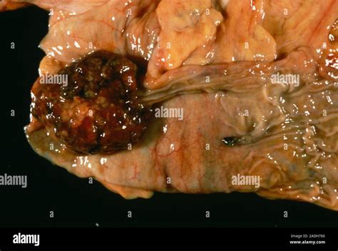 Villous Adenomas Sectioned Gross Clinical Specimen Of The Human Colon With Benign Non