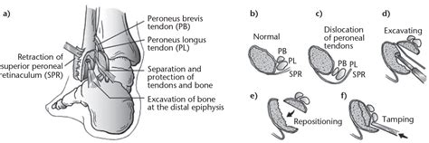 Peroneal Tubercle