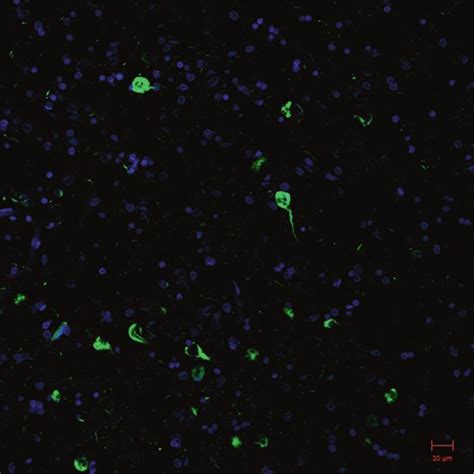 1 Hyperphosphorylated Tau Formed Tangles In The Ad Human Brain Human