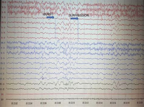 Eeg Showing Burst Suppression Pattern On Midazolam Infusion Eeg
