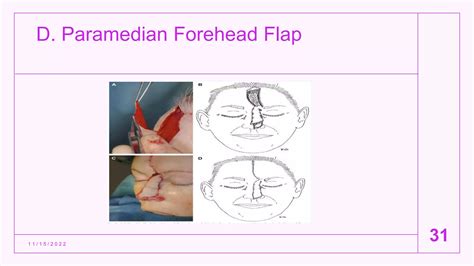 Nasal Reconstruction Pptx