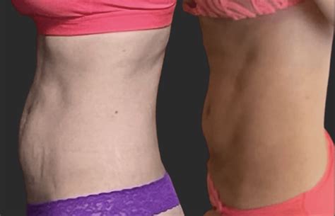 Emsculpt Calves Before And After At Bonnie Tyler Blog