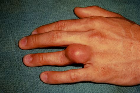 Osteochondroma Hand Surgery Resource