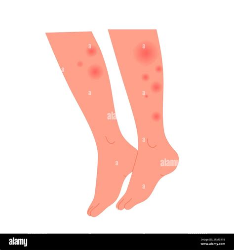Human Legs Covered With Red Rash Feet With Allergic Reaction Skin