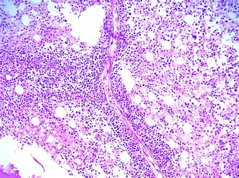 Bone Marrow Cells Under Microscope